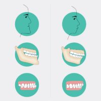 Differences between Overbite & Underbite | Treatment Options