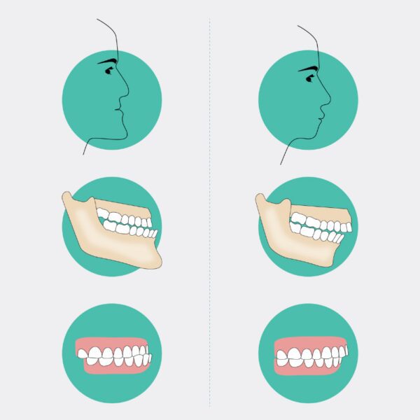 Differences between Overbite & Underbite | Treatment Options
